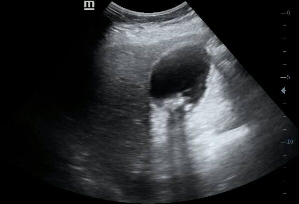 Sonographic Murphy’s sign - Global Ultrasound Institute