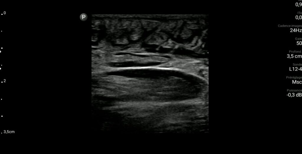 Cellulitis Archives - Global Ultrasound Institute
