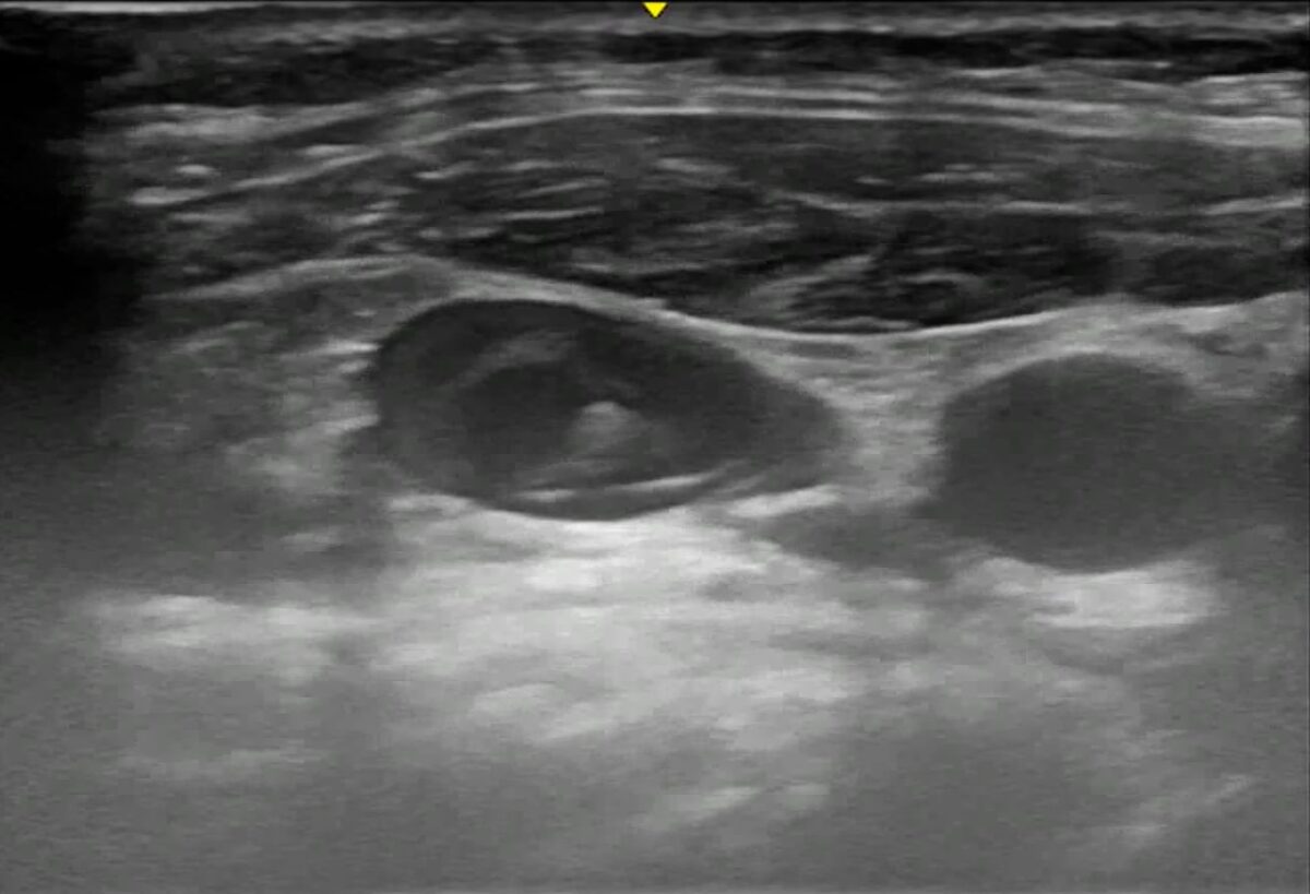 DVT Archives - Global Ultrasound Institute