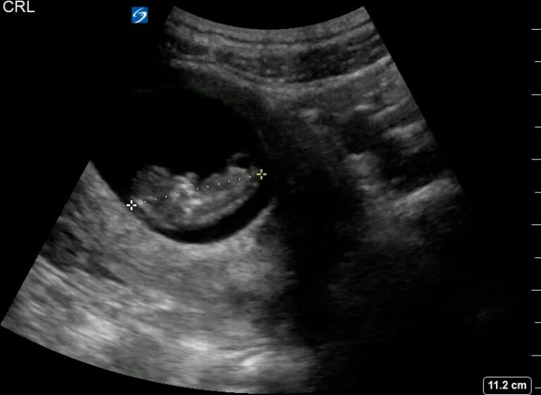 Fetal Pole Archives - Global Ultrasound Institute