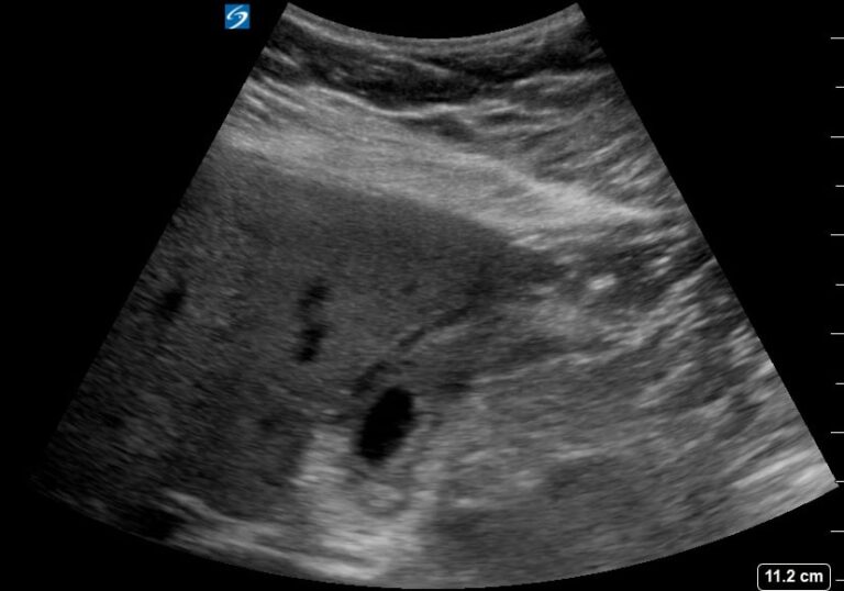 Pericholecystic fluid - Global Ultrasound Institute