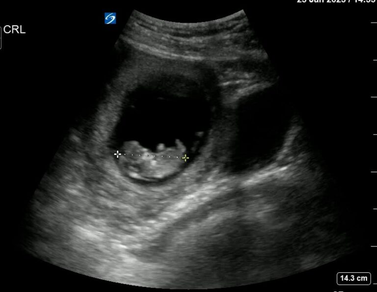 Fetal pole - Global Ultrasound Institute