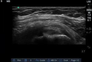 Rotator cuff tear - Global Ultrasound Institute